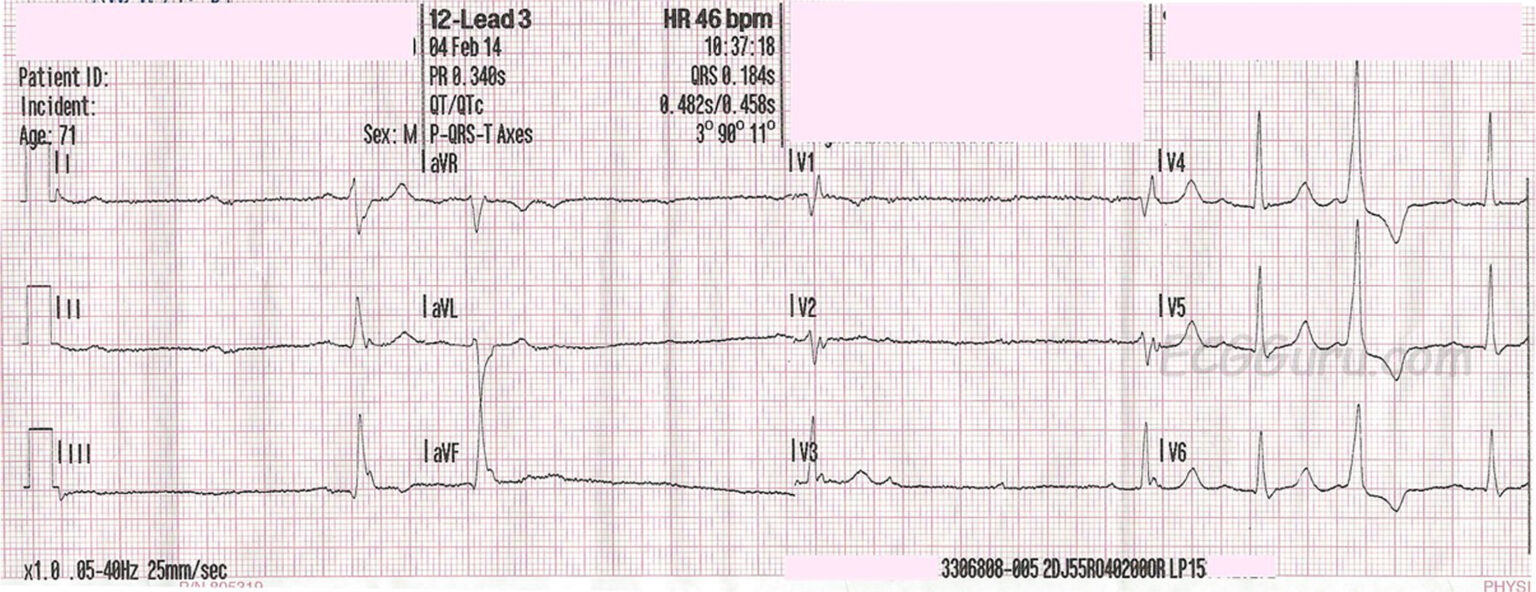 IMH Case Of the Week – Heart Block and its treatment with Pacemaker ...