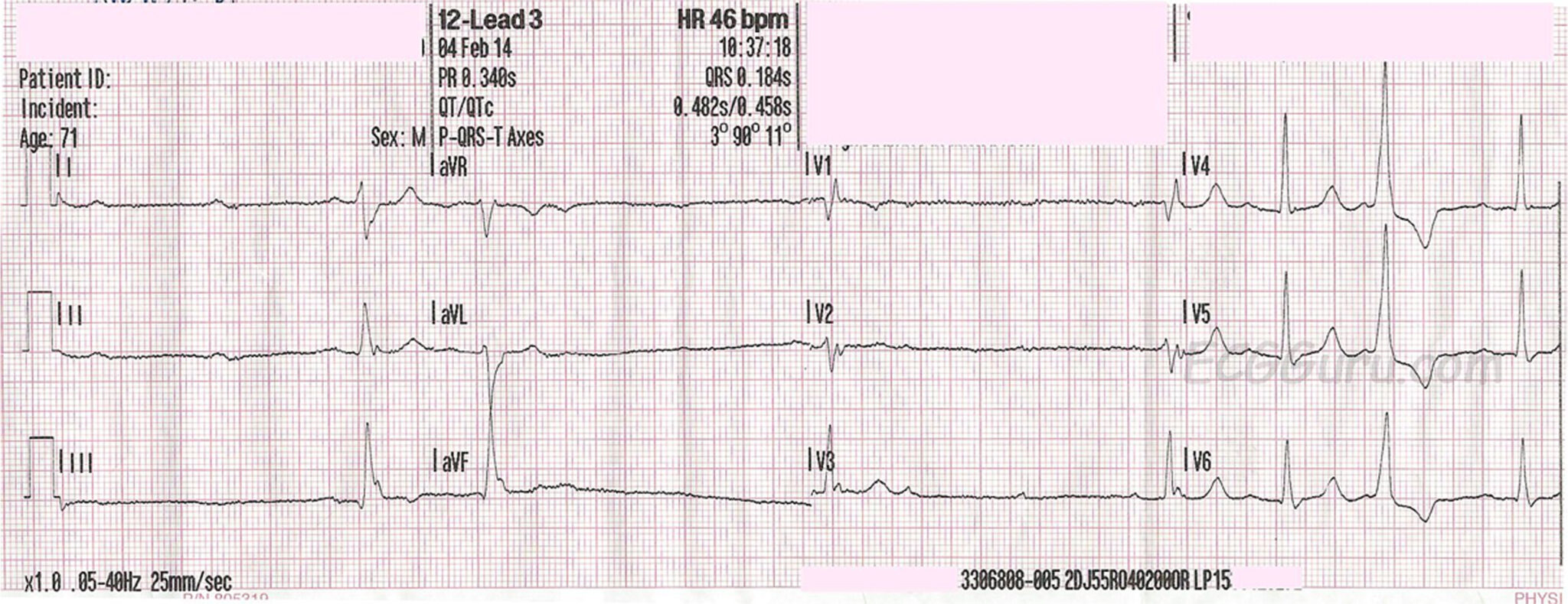 IMH Case Of the Week – Heart Block and its treatment with Pacemaker ...